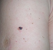 Maligni tumori kože, karcinom koze