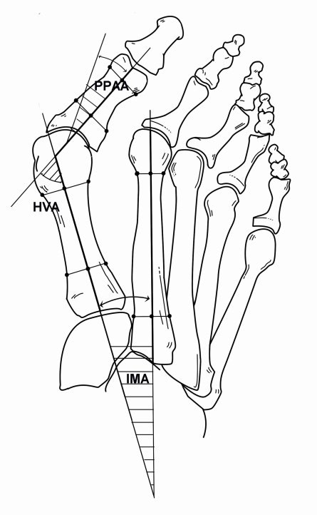 Čukljevi (Hallux valgus) - uzork, simptomi, lečenje