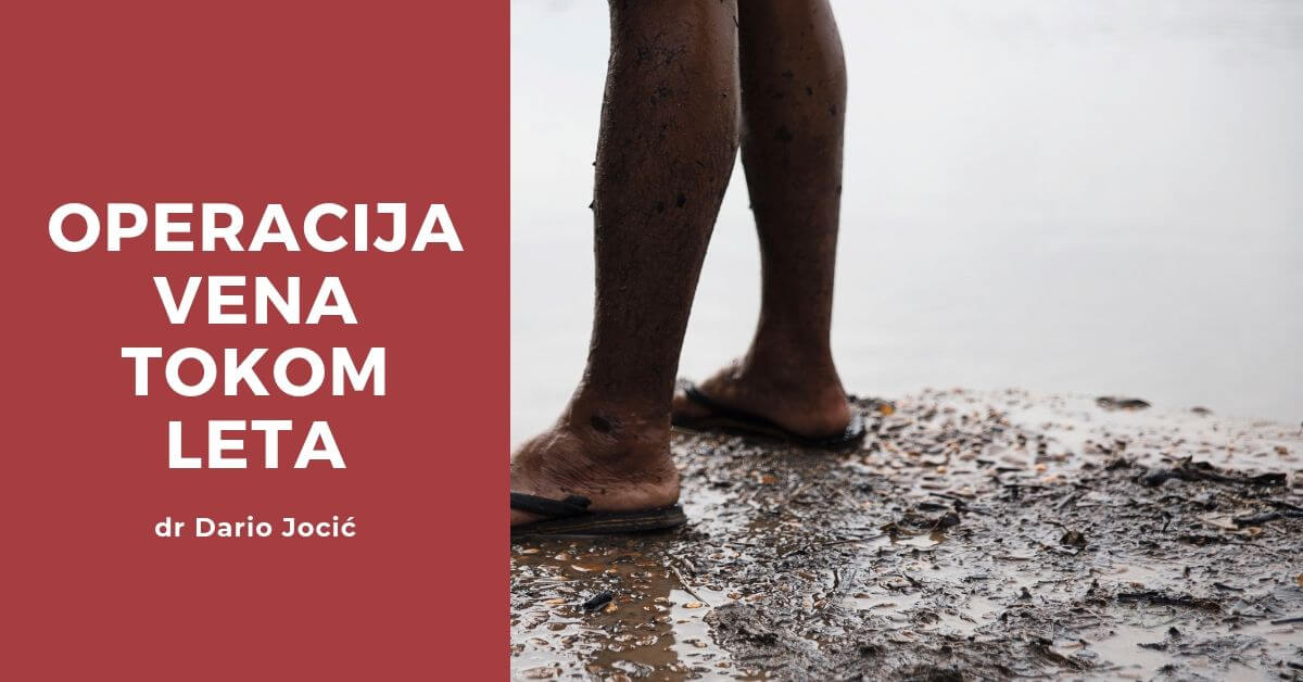 Operacija vena tokom leta - dr Dario Jocić - sve informacije