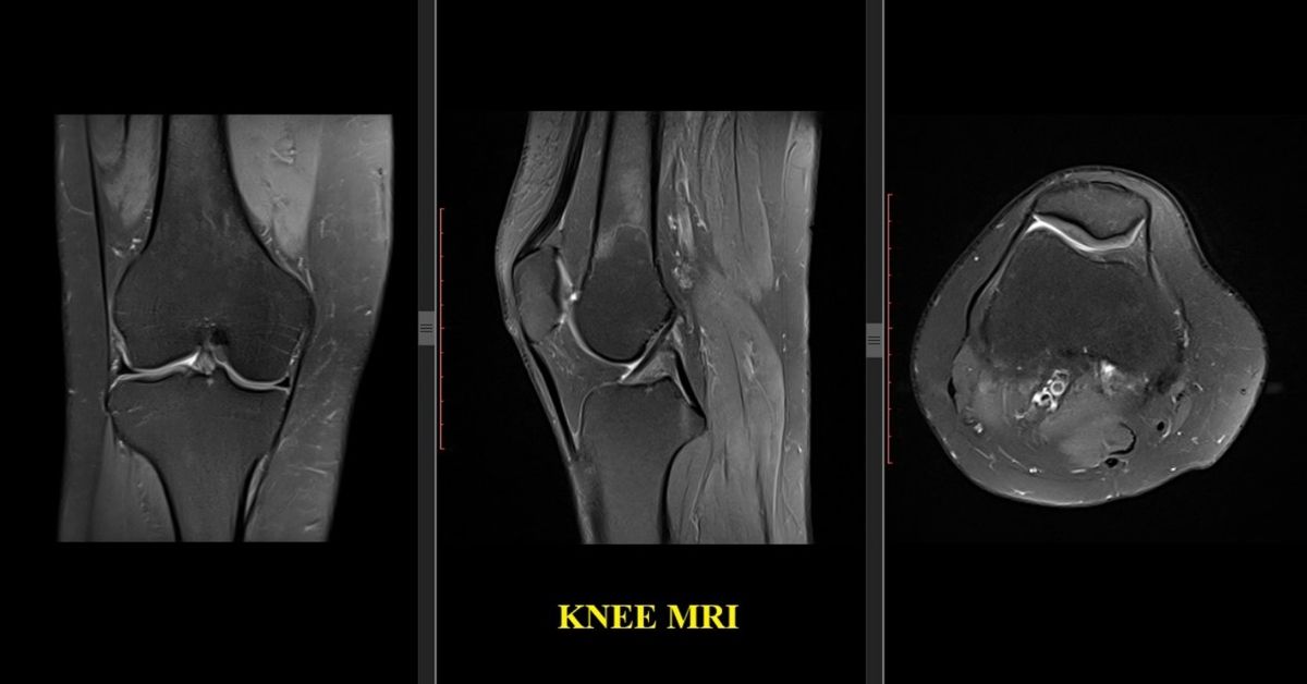 Magnetna rezonanca kolena (MR kolena)