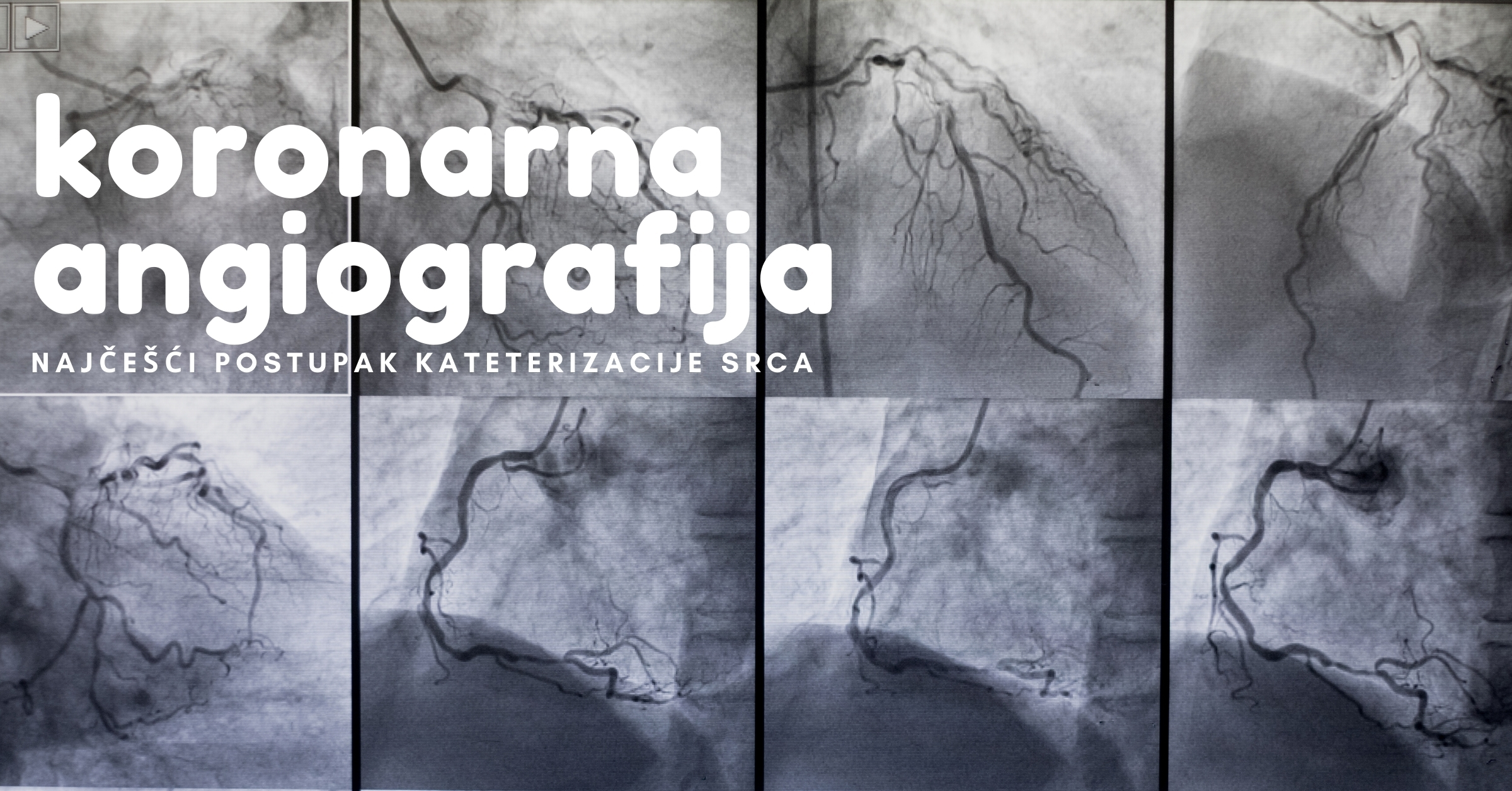Koronarna angiografija: sve informacije